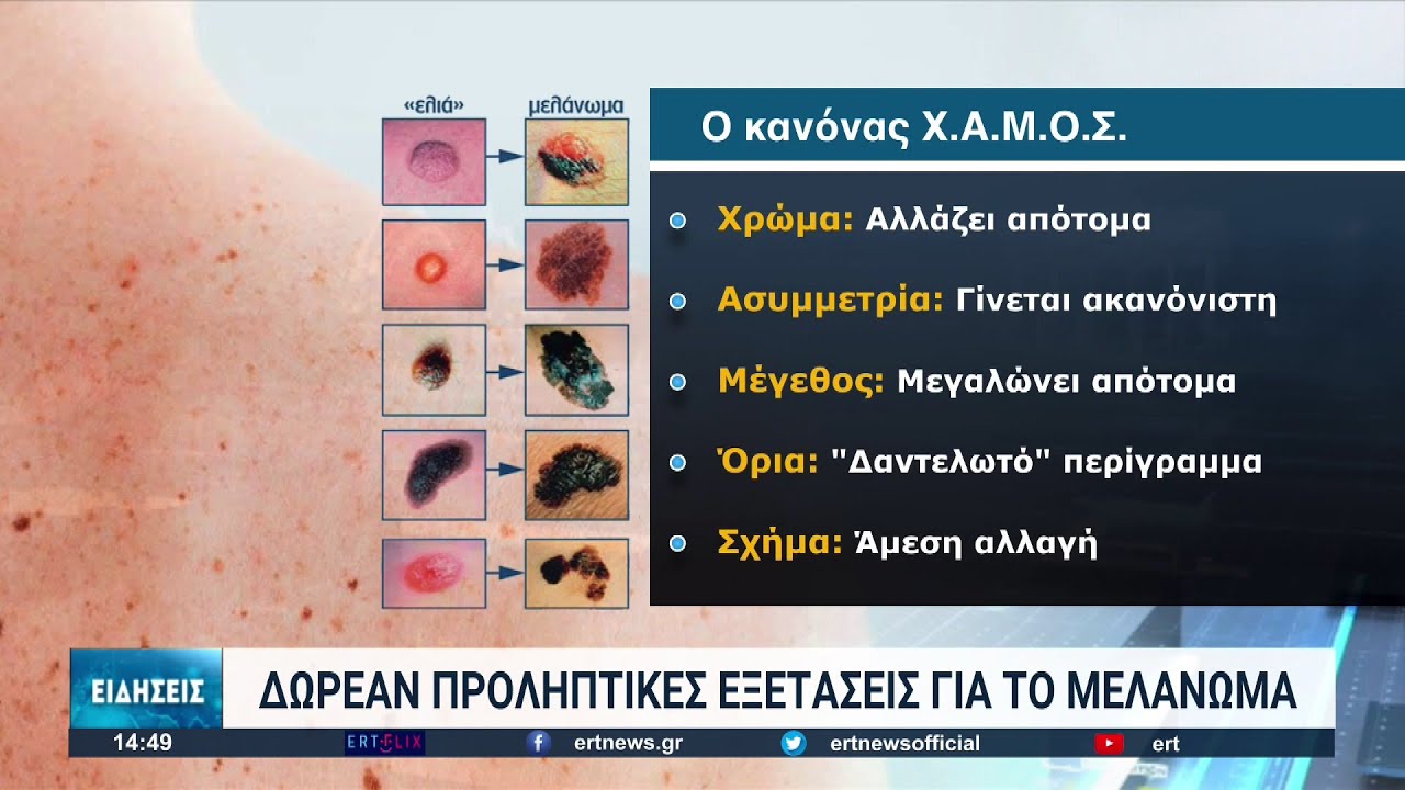 Μελάνωμα: Ο ύπουλος καρκίνος του δέρματος που θεραπεύεται όταν ...